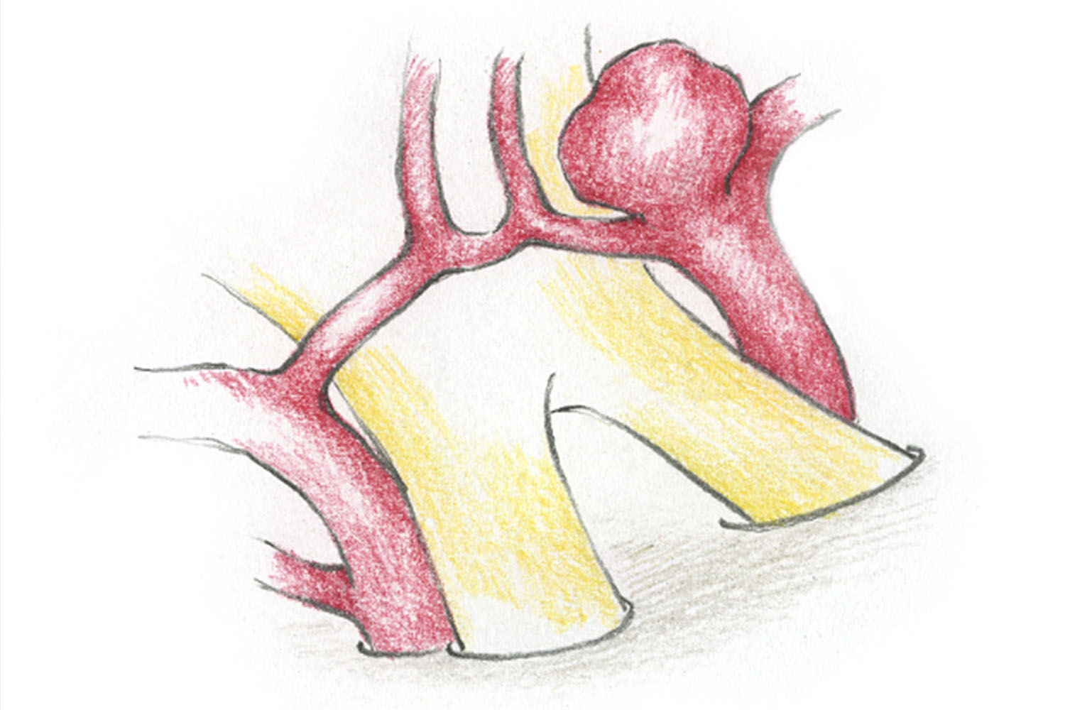 Hirngefässerkrankungen – Endomin