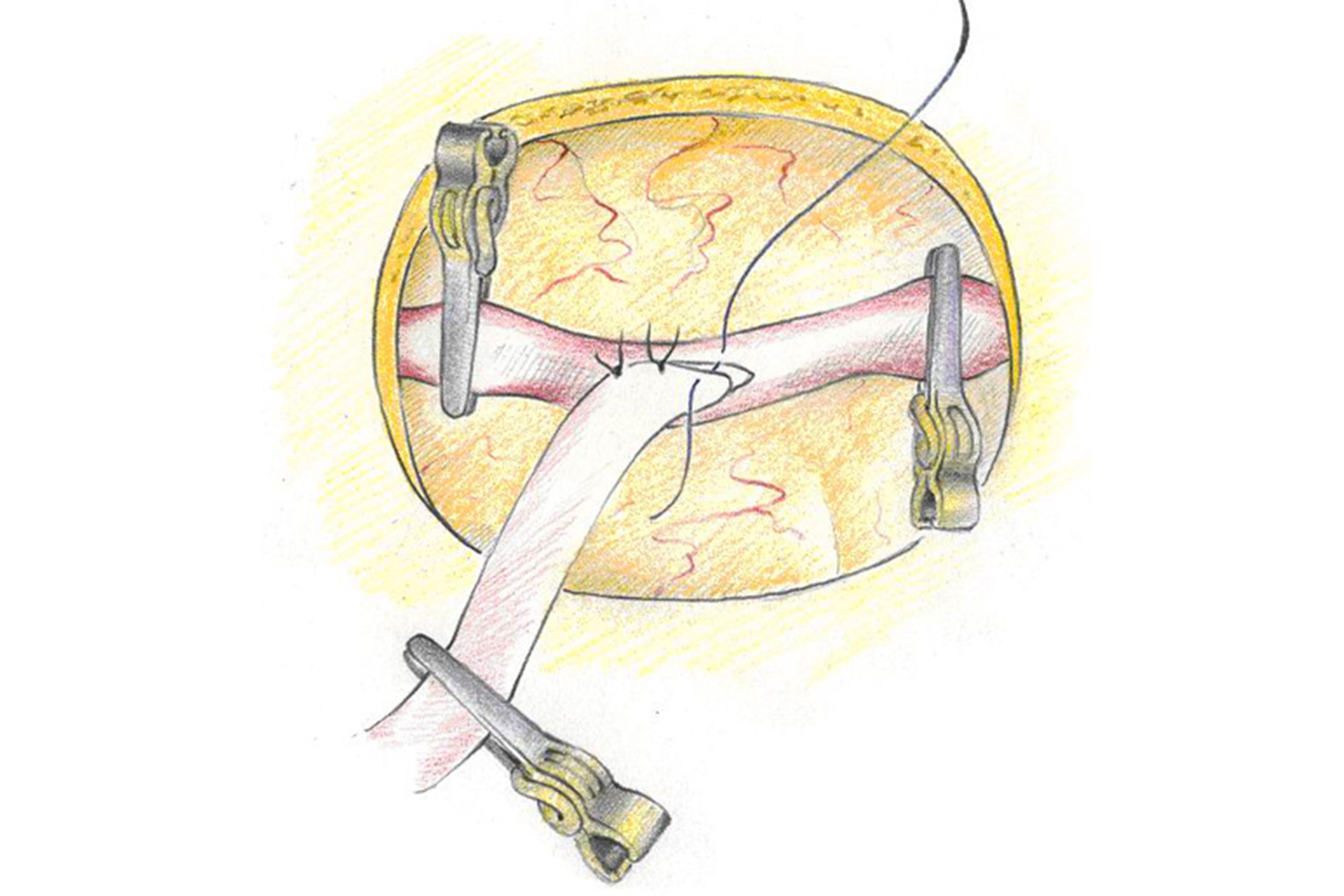 Hirngefässerkrankungen – Endomin