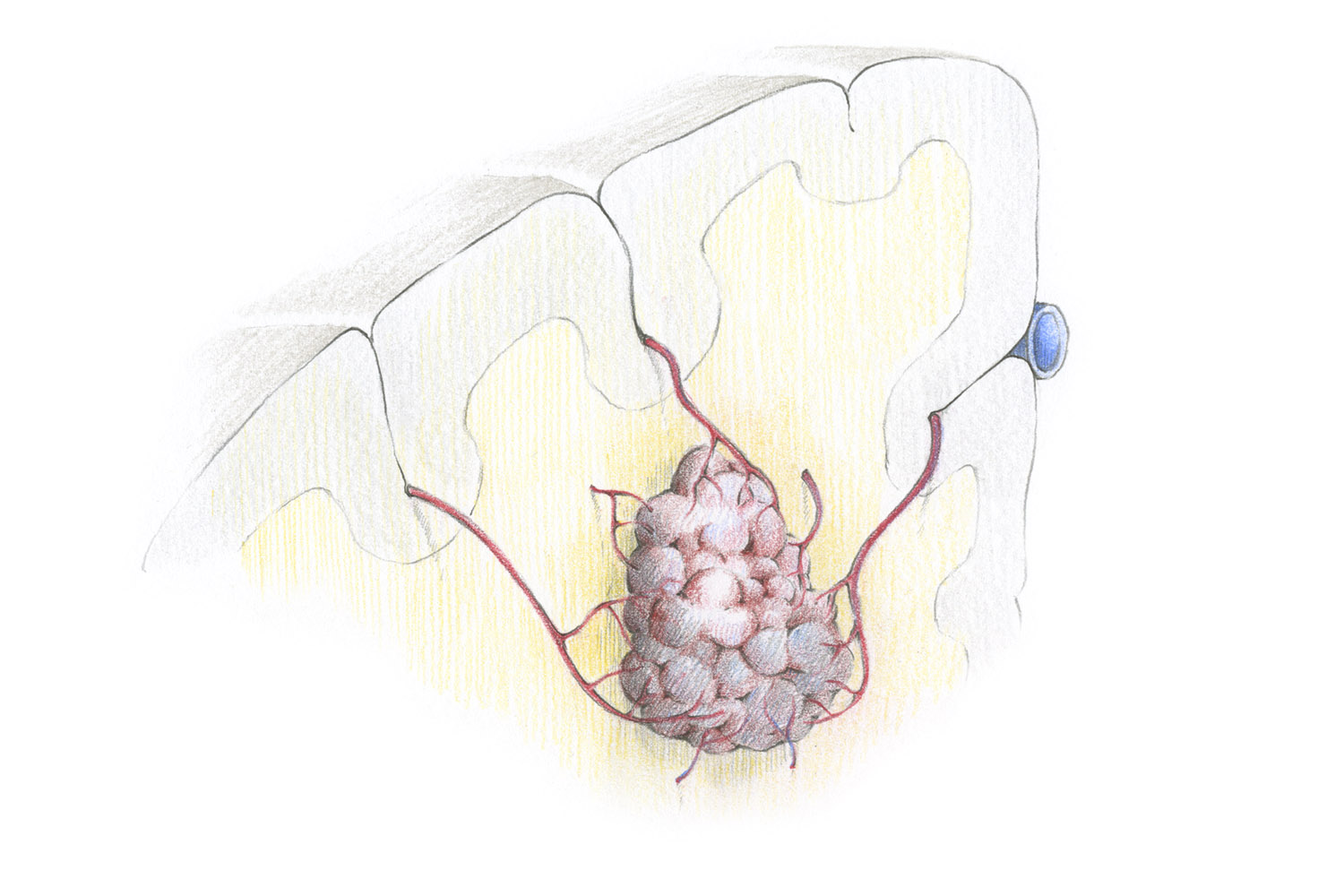 Hirngefässerkrankungen – Endomin