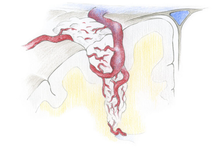 Hirngefässerkrankungen – Endomin