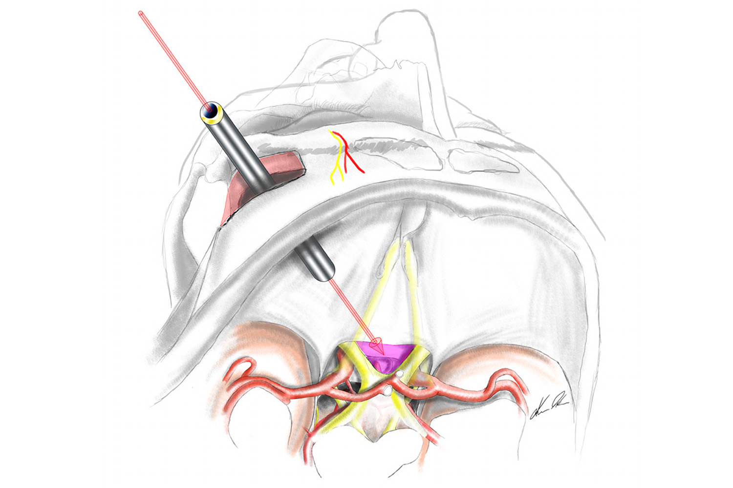 Minimal Invasive Neurochirurgie – .Zentrum für Neurochirurgie Zürich