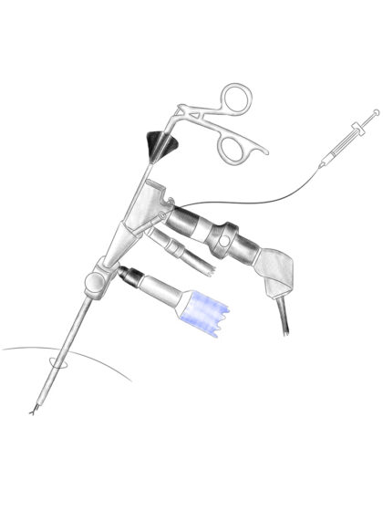 Minimal Invasive Neurochirurgie – .Zentrum für Neurochirurgie Zürich