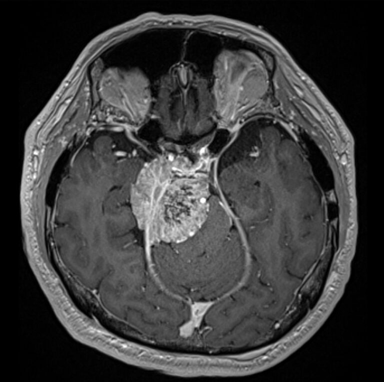 Hirn Schädelbasis und Rückenmarkstumore – Endomin